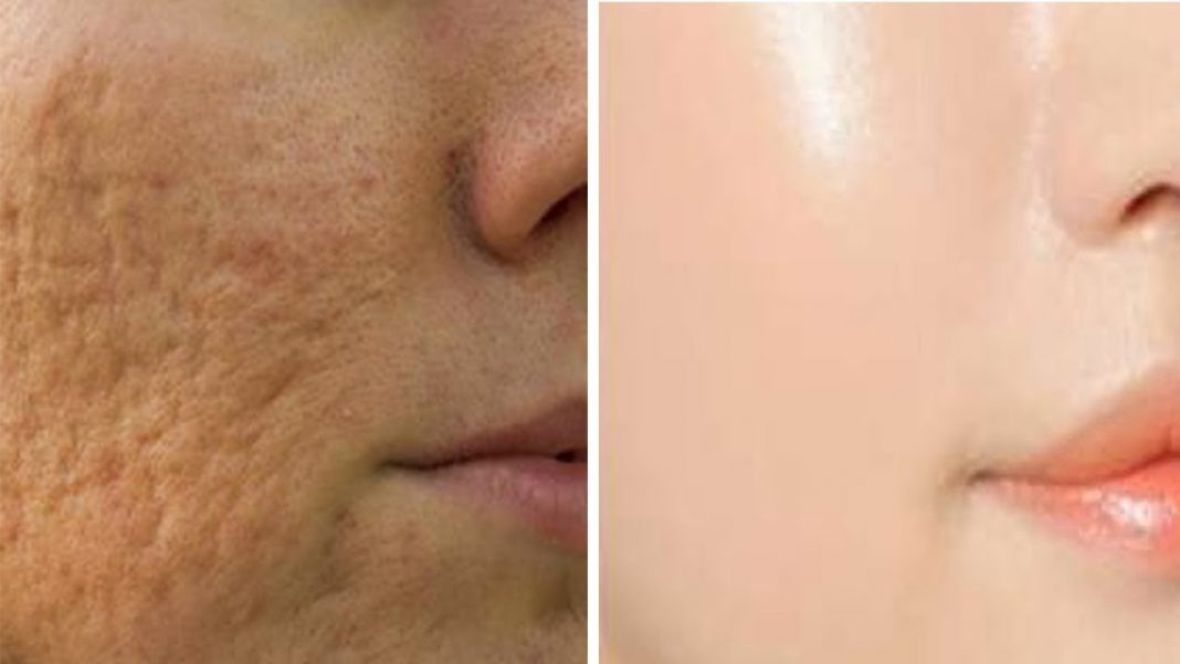 Open Pores | Open Pores Treatment in Delhi | Open Pores Treatment Cost